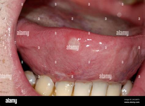 Close Up Of An Aphthous Ulcer On The Tongue Of A 27 Year Old Male Patient Aphthous Ulcers