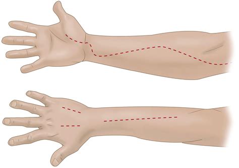 Left Upper Extremity Fasciotomy Closure Necrosis And 47 Off