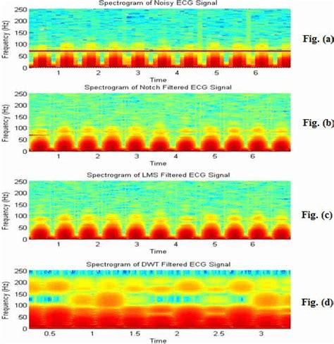 Spectrogram Output Of A Noisy Ecg Signal B Notch Filtered Ecg
