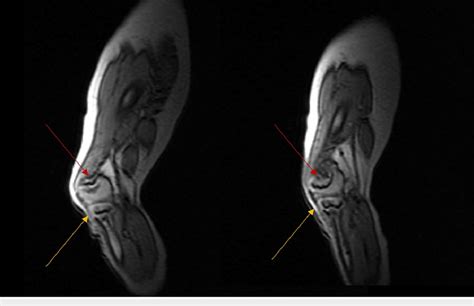 Magnetic Resonance Imaging Of The Left Knee Without Contrast Sagittal Download Scientific