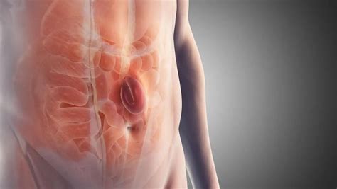 Hernia Recurrence Expert Tips By Dr Srivatsan To Prevent It