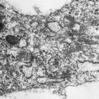 Tumor Cell With Numerous Dilated Cisternae Of Endoplasmic Reticulum Download Scientific