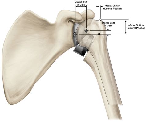What S The Difference Between A Shoulder Replacement And A Reverse Shoulder Replacement At