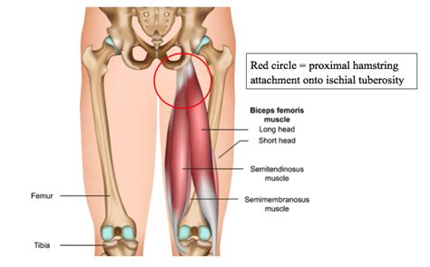 Proximal Hamstring Tendinopathy Causes Symptoms And Effective