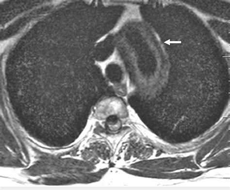Preoperative Mri T2 Axial Showing A Dilated Thoracic Aorta With A