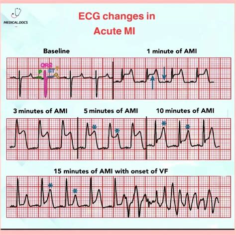 Mi Ekg