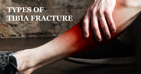 Types Of Tibia Fracture Welcome To Sys Medtech International Private