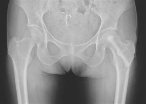 Hip Core Decompression Surgery Hip Preservation Treatment Manhattan New York City Ny