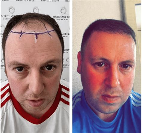 Forehead Reduction Vs Hair Transplant
