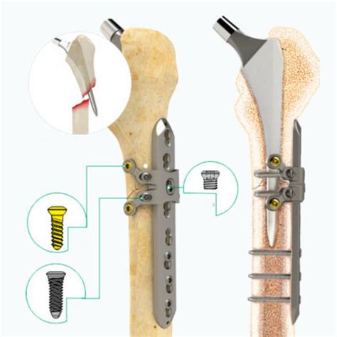 Компрессионная костная пластина большеберцовая кость 2912 Series Zimed Medical блокируемая
