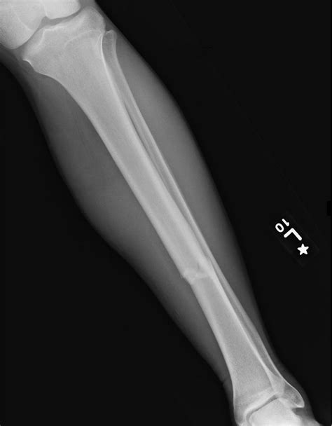 Tibial Shaft Fractures Trauma Orthobullets