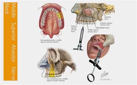 Local Anesthesia Maxillary Blocks At Conrad Williams Blog