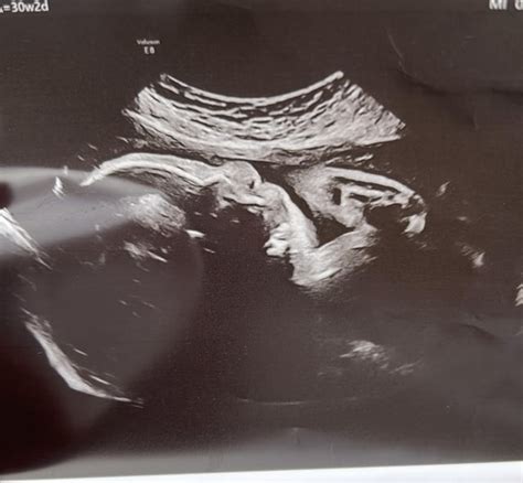 Brown Spotting 5 Weeks Pregnant Rpregnancyproblems