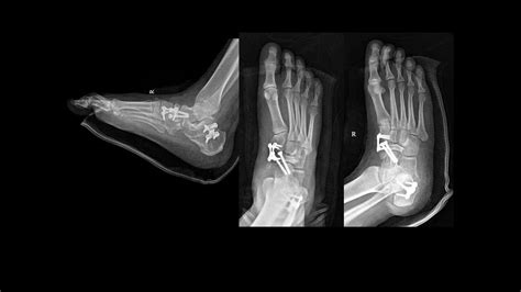 Pttd Acquired Pes Planus Pdf