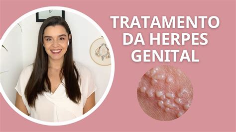 Herpes Genital Feminina