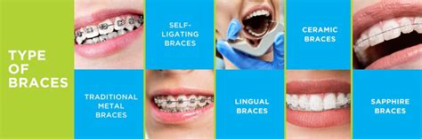 Metal Braces Vs Clear Braces Pros And Cons Image Orthodontics