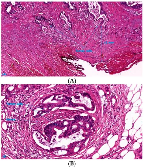 Pathologic Implications Of Radial Resection Margin And Perineural