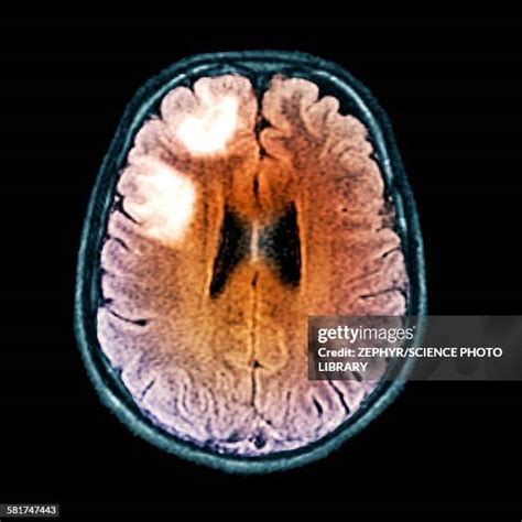 Leukoencephalopathy Photos And Premium High Res Pictures Getty Images