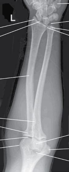 Ap Forearm Projection X Ray Anatomy Diagram Quizlet