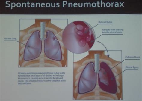 Spontaneous Pneumothorax Bleb