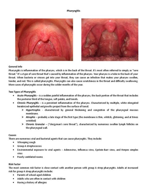 Pharyngitis Pdf Health Sciences Respiratory Diseases