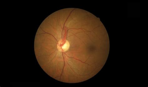 Prepapillary Vascular Loop Retina Today