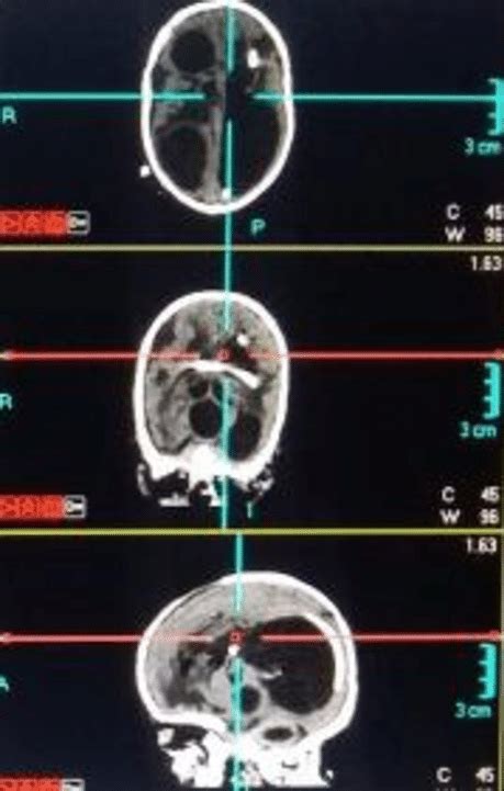 Ct Scan With Multi Planar Reconstruction Mpr Views Of Evd Tube