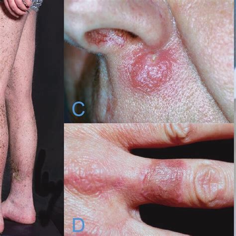 A B Patient With Xeroderma Pigmentosum With Hyperpigmentation Of