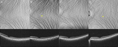 12 X 12 Mm En Face Oct Of The Choroid And 12 Mm Horizontal B Mode Oct