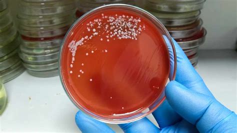 Come Si Manifesta Lo Streptococco Negli Adulti Torrinomedica