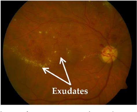 Figure 1 From Automated Exudates Detection In Retinal Fundus Image
