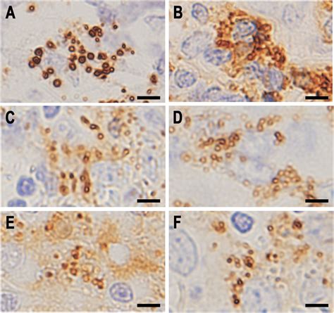 Higher Magnification Of Small Round Bodies Detected In The Lymphatic Download Scientific