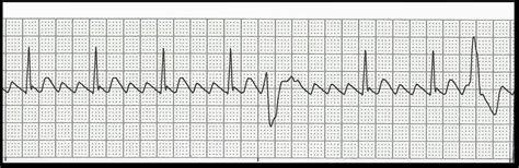 Float Nurse Various Rhythms With Multifocal Pvcs