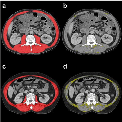 Figure 1 From Preoperative Ct Based Skeletal Muscle Mass Depletion And