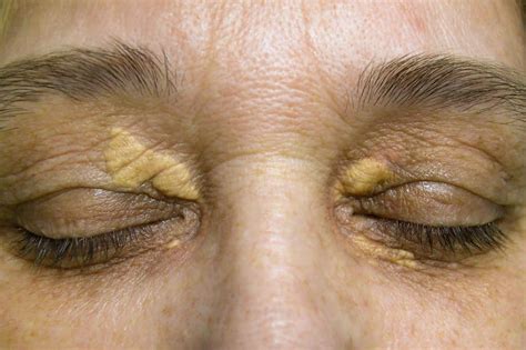 Xanthelasma Vie Aesthetics