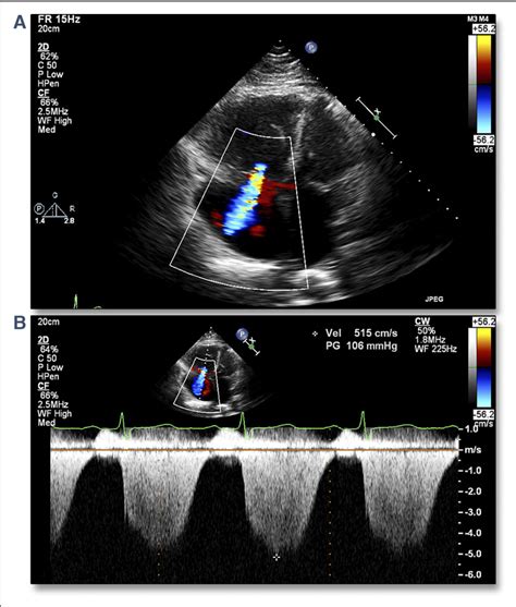 Figure 1 From Echocardiography In Liver Transplant Candidates Semantic Scholar