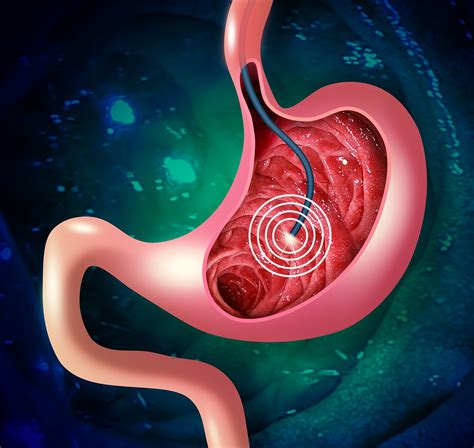 Endoscopic Ultrasound Eus Melbourne Vic — Gastroenterology Specialist