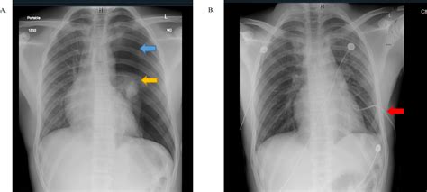 Primary Spontaneous Pneumothorax With An Apical Bleb Controversies In