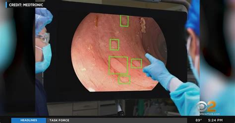 New Ai Helps Detect Potentially Cancerous Polyps In The Colon Cbs New York