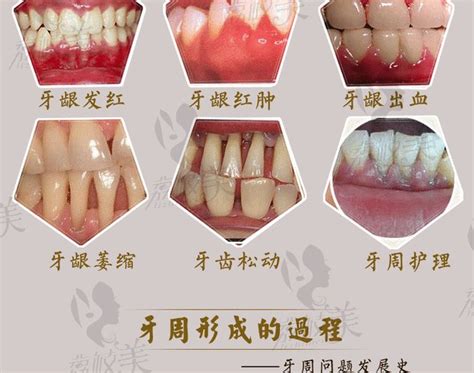 正常的牙龈和萎缩对比 轻度 第3页 大山谷图库