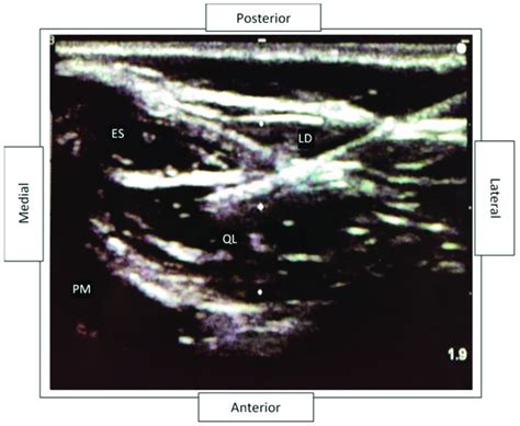 Ultrasound Of Block Administration Plan Ql Quadratus Lumborum Download Scientific Diagram