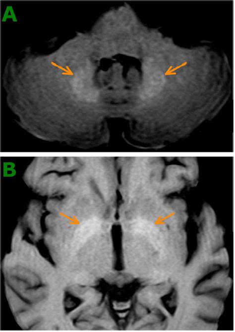 Conspicuous Hyperintense Dentate Nucleus A And Globus Pallidus B On