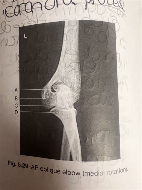 AP Oblique Medial Rotation Diagram Quizlet