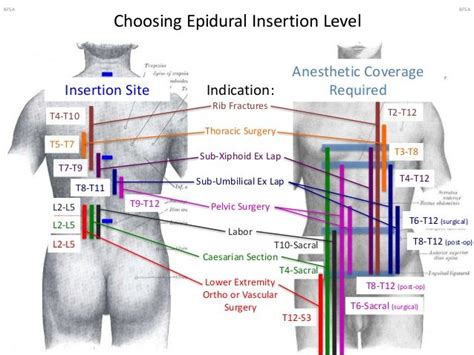Insertion Site And Epidural Level Needed For Different Surgeries