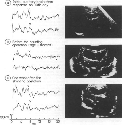 Effect Ofshunting On The Auditory Brain Stem Response In An Infant Born Download Scientific