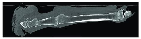 Sagittal Ct Image Bone Algorithm Ww1500 Wl300 From Postmortem