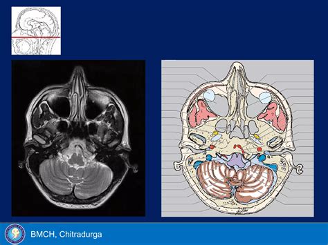 Cochlear Implant Imaging Ppsx