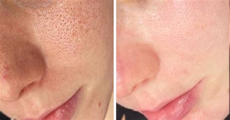 Minute Secret To Shrink Skin Large Pores On Face Glowpink