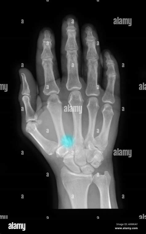 Broken Metacarpal X Ray