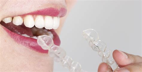 Brackets With Invisalign At Dennis Marquis Blog